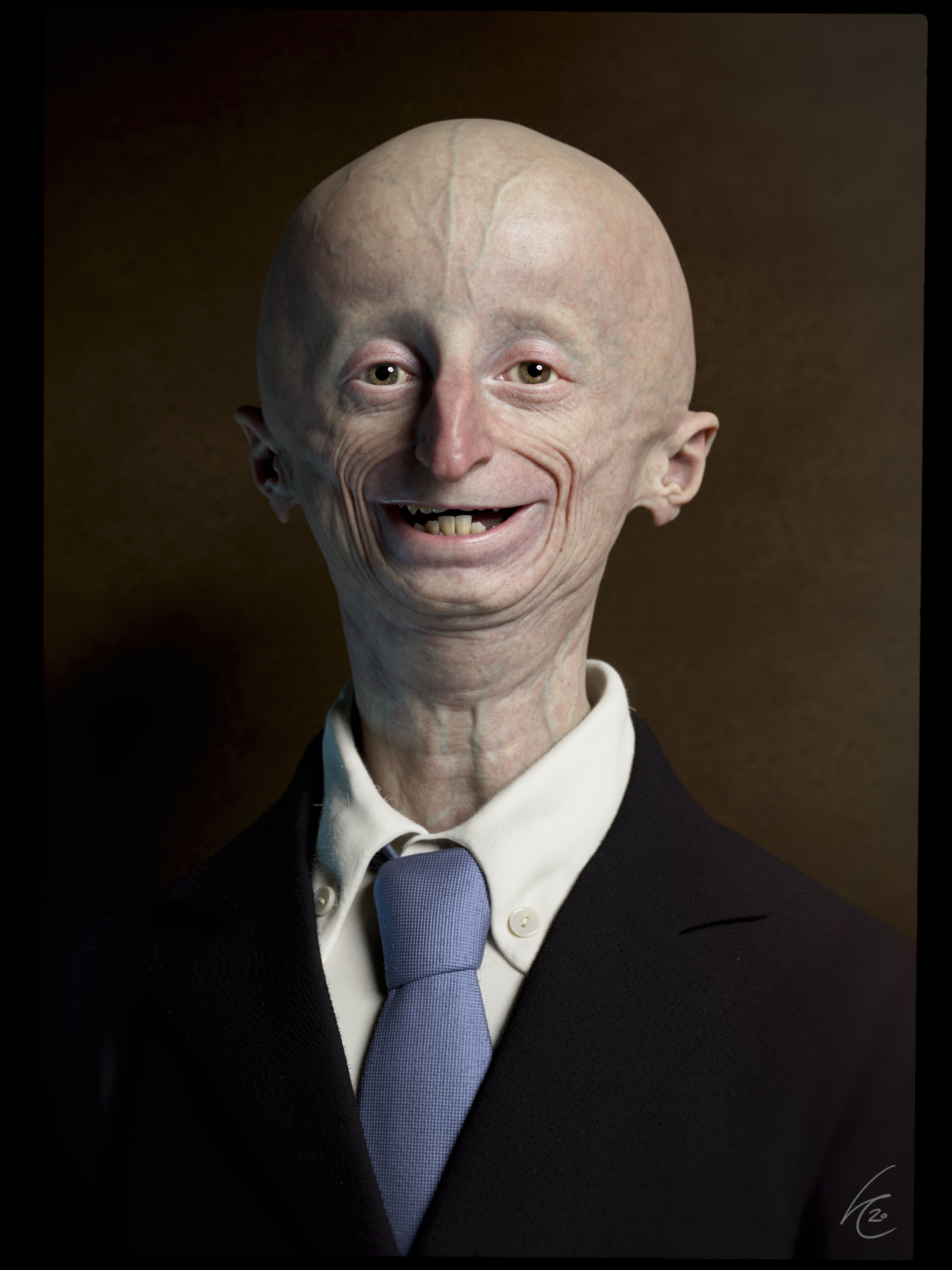 Progeria Sam Berns